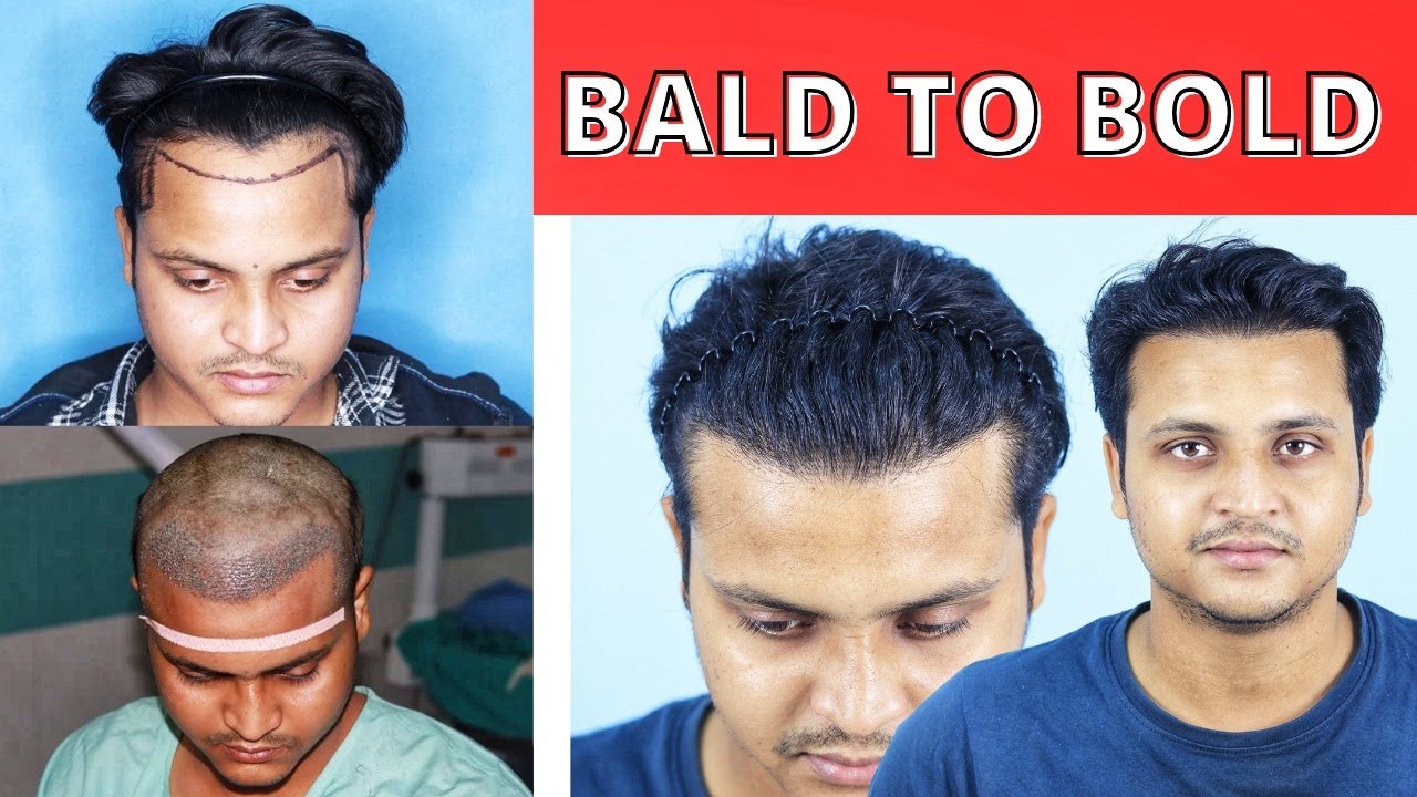 Case Study : The Most Natural Hairline One Can Ever Get After Hair ...