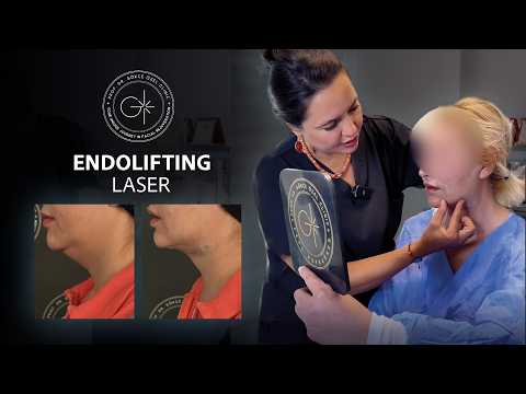 İŞLEM SONRASI İLK GÖRÜNÜM: DAHA BELİRGİN BİR JAWLINE, DAHA İNCE BİR BOYUN! #endolift #gıdı #jawline