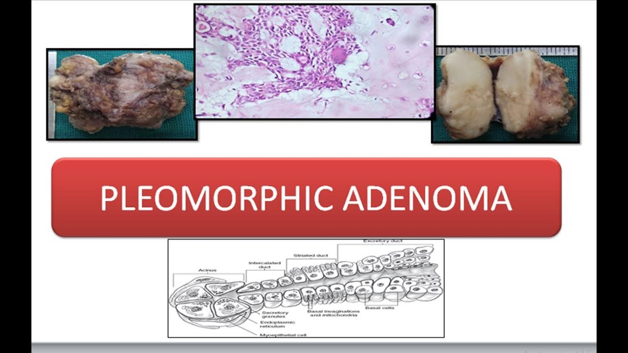 Pleomorphic Adenoma Youtube