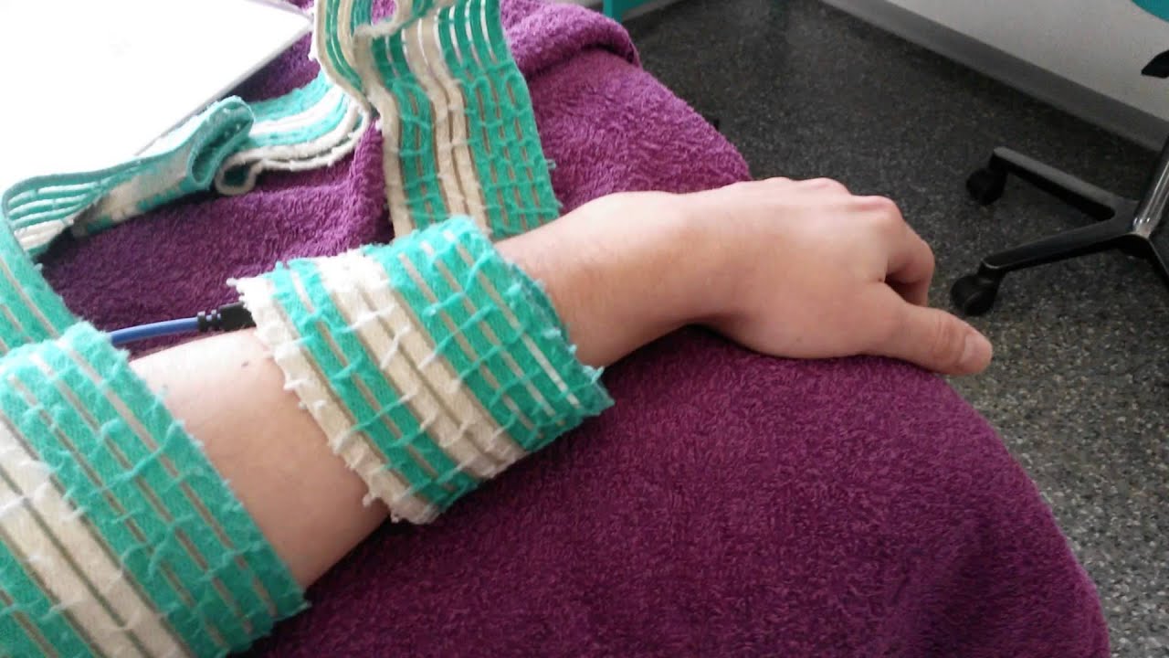 Elektrotherapie - Radialisparese - YouTube