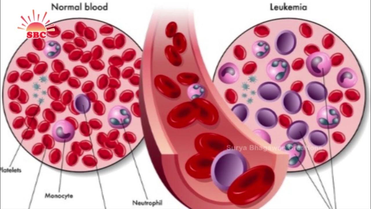 If You Have These Signs Then You Have Blood Cancer eshwartv YouTube if-you-have-these-signs-then-you-have-blood-cancer-eshwartv-youtube