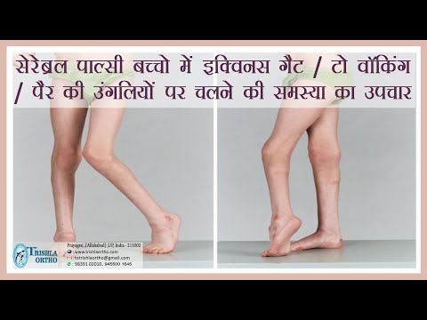 Equinus gait in cerebral palsy : management - YouTube