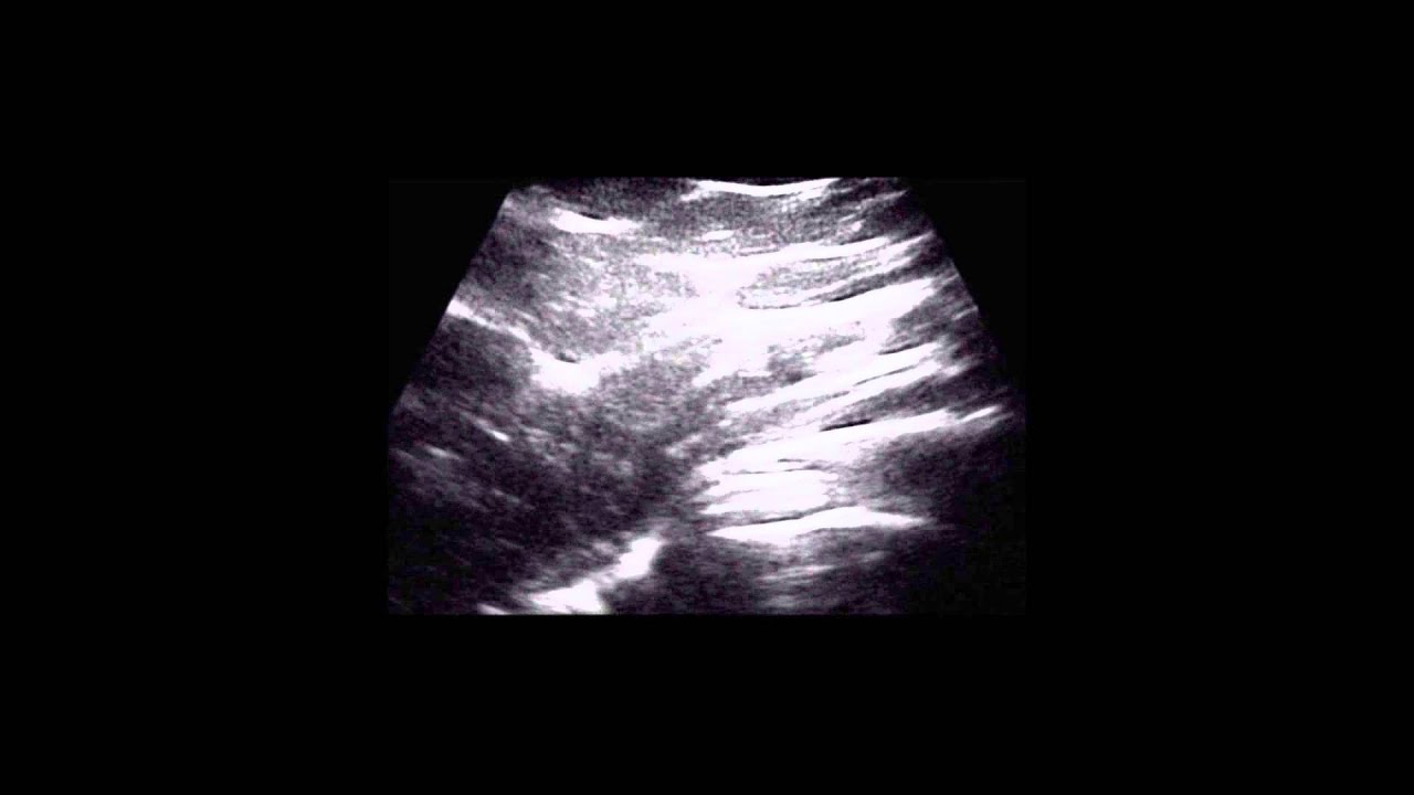 Snapping of the iliotibial band over the greater trochanter at US ...