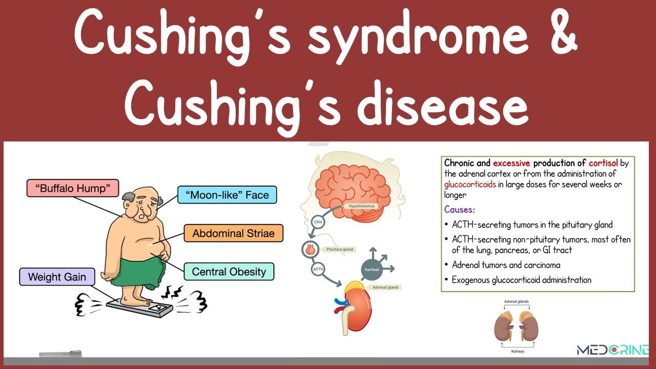Cushing’s Syndrome vs Cushing’s Disease | Causes, Diagnosis, Symptoms ...