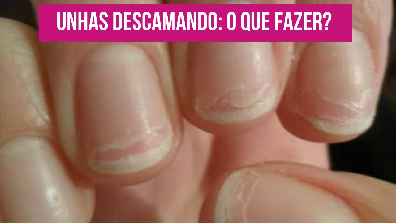 UNHAS DESCAMANDO: E AGORA? CAUSAS E O QUE FAZER - YouTube
