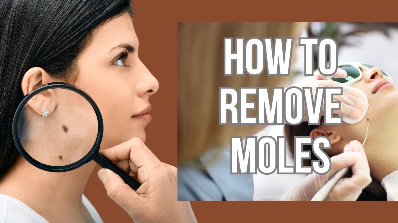 How to Safely Remove Moles on Face and Body | Dr. Atif Kazmi - YouTube