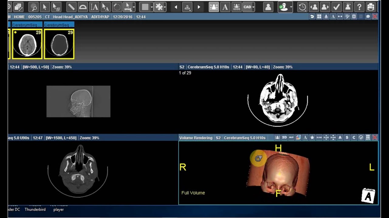 Hanging Protocol - Saince Merge PACS - YouTube