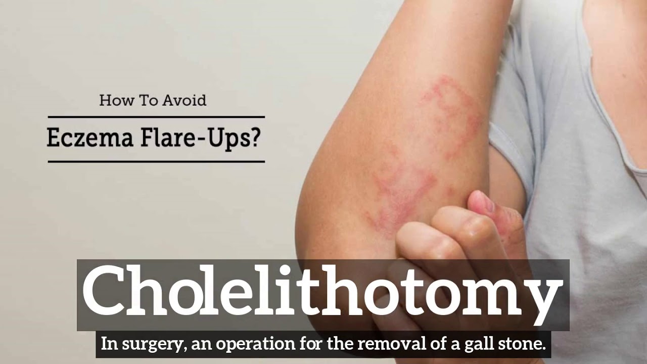 What Is Cholelithotomy How Does Cholelithotomy Look How To Say Cholelithotomy In English what-is-cholelithotomy-how-does-cholelithotomy-look-how-to-say-cholelithotomy-in-english