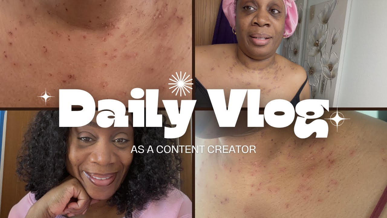 Snowed In | I had my moles removed and it was painful | New Wig - YouTube