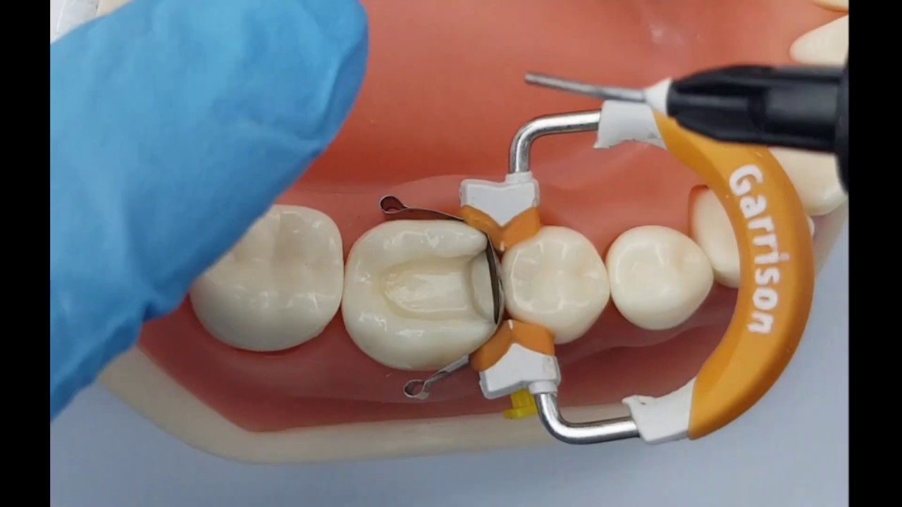 Class II Composite - YouTube