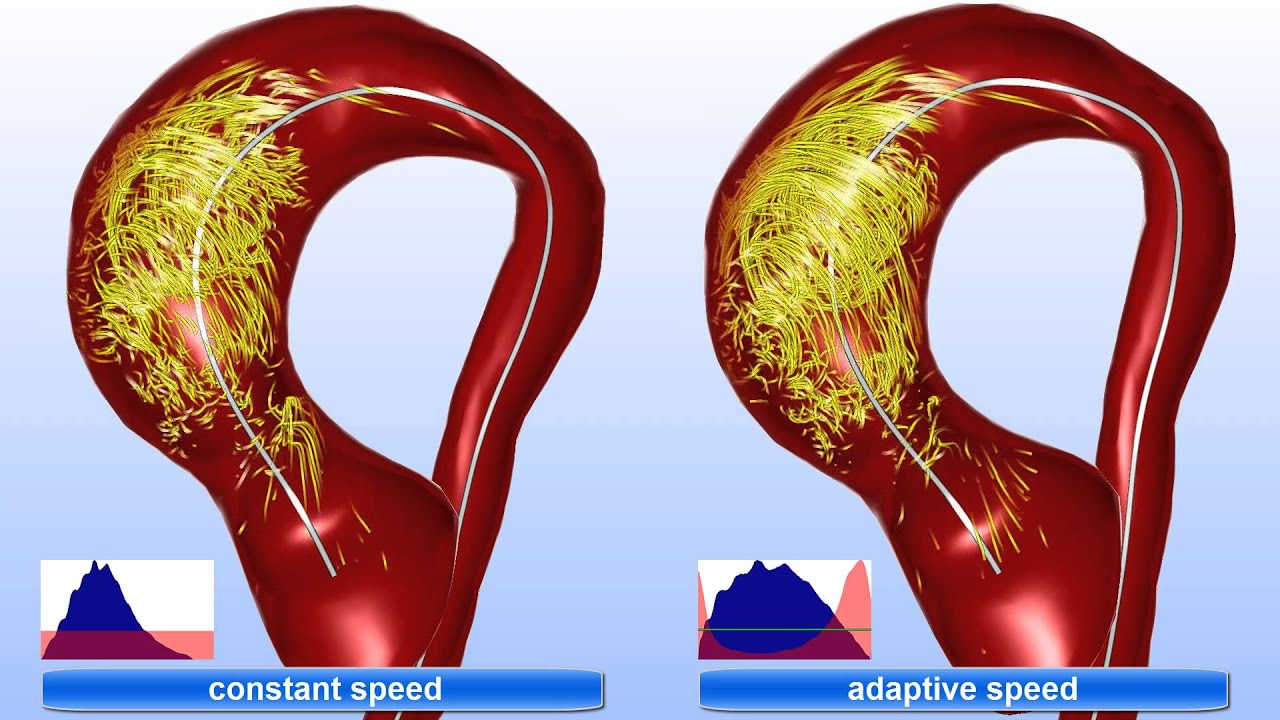 VAAS - Adaptive Animations of Vortex Flow Extracted from Cardiac 4D PC ...