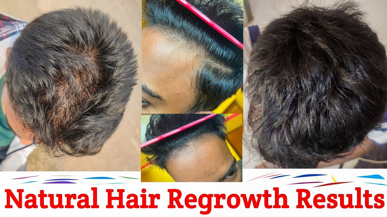 Hair Regrowth Results Before and After Client - YouTube