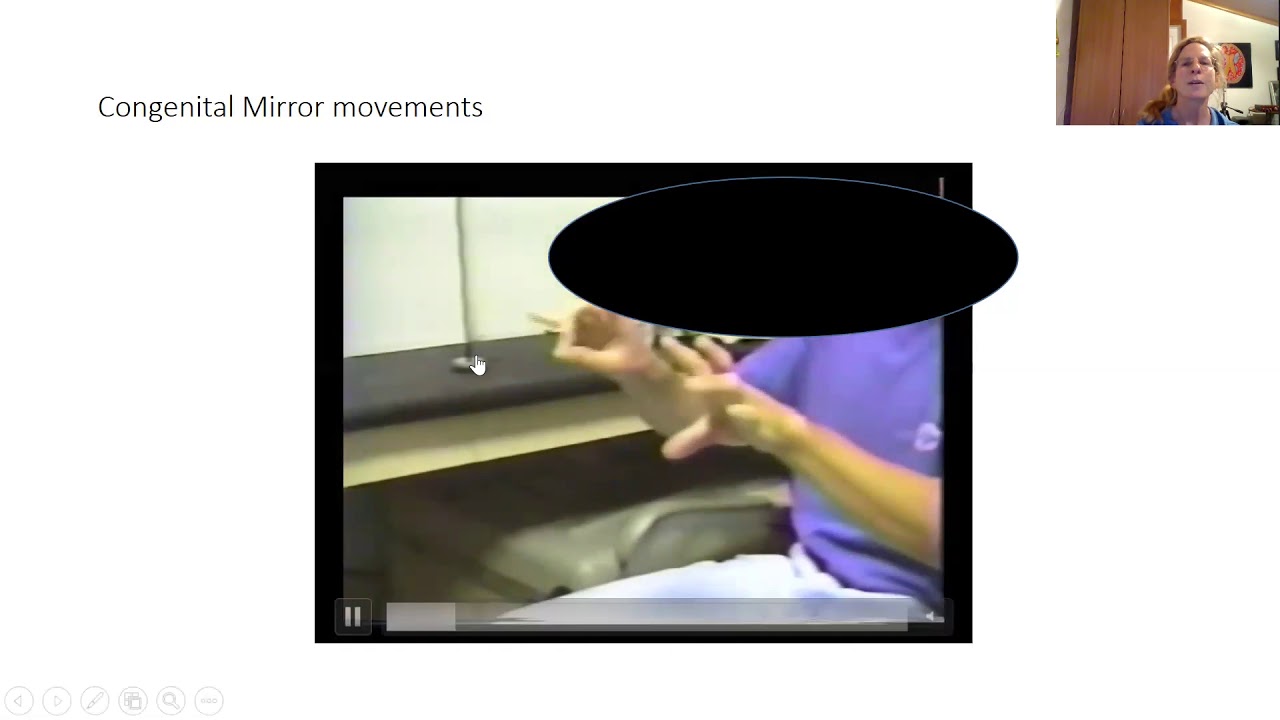 Congenital Mirror Movements - YouTube