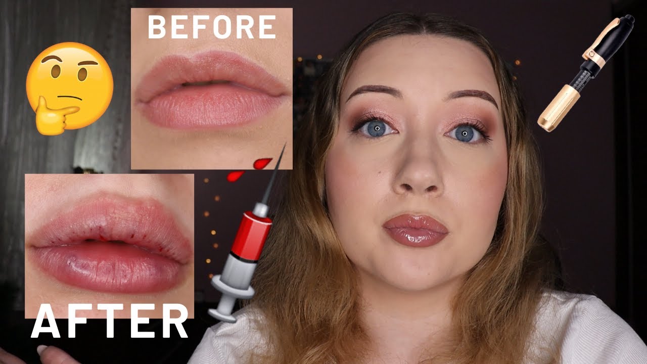 I got ''PAIN-FREE'' LIP FILLER? | HYALURON PEN | GLAM_DIARY - YouTube