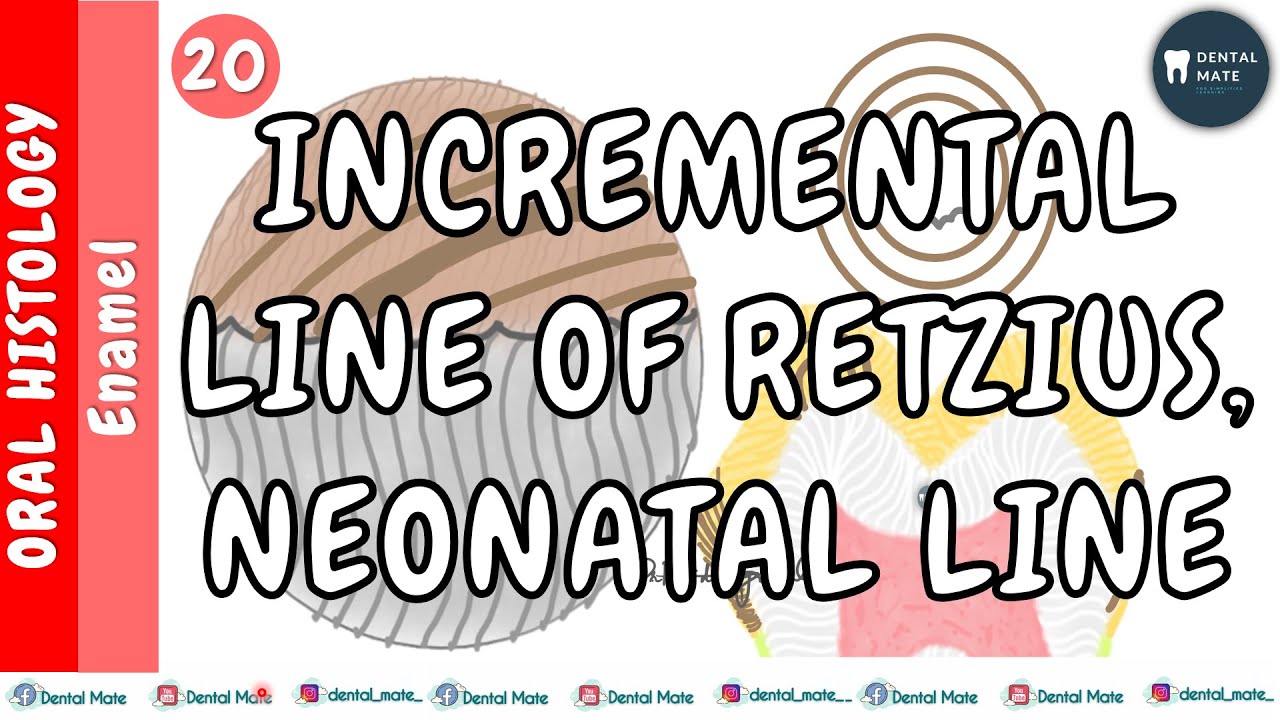 Incremental line of retzius | Straie of retzius | Neonatal line of ...