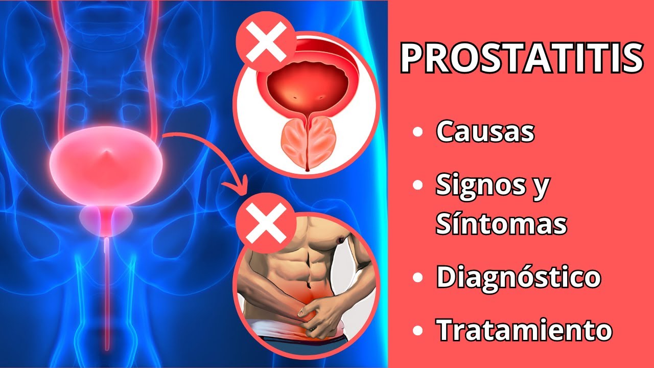 PROSTATITIS - Causas, signos y síntomas, diagnóstico y tratamiento ...