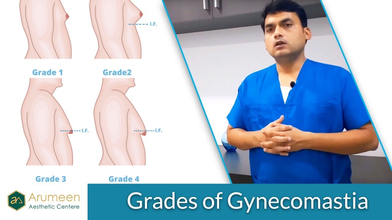 Grades of Gynecomastia || Different types of gynecomastia ...