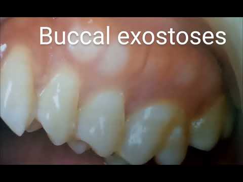 Buccal exostoses - YouTube