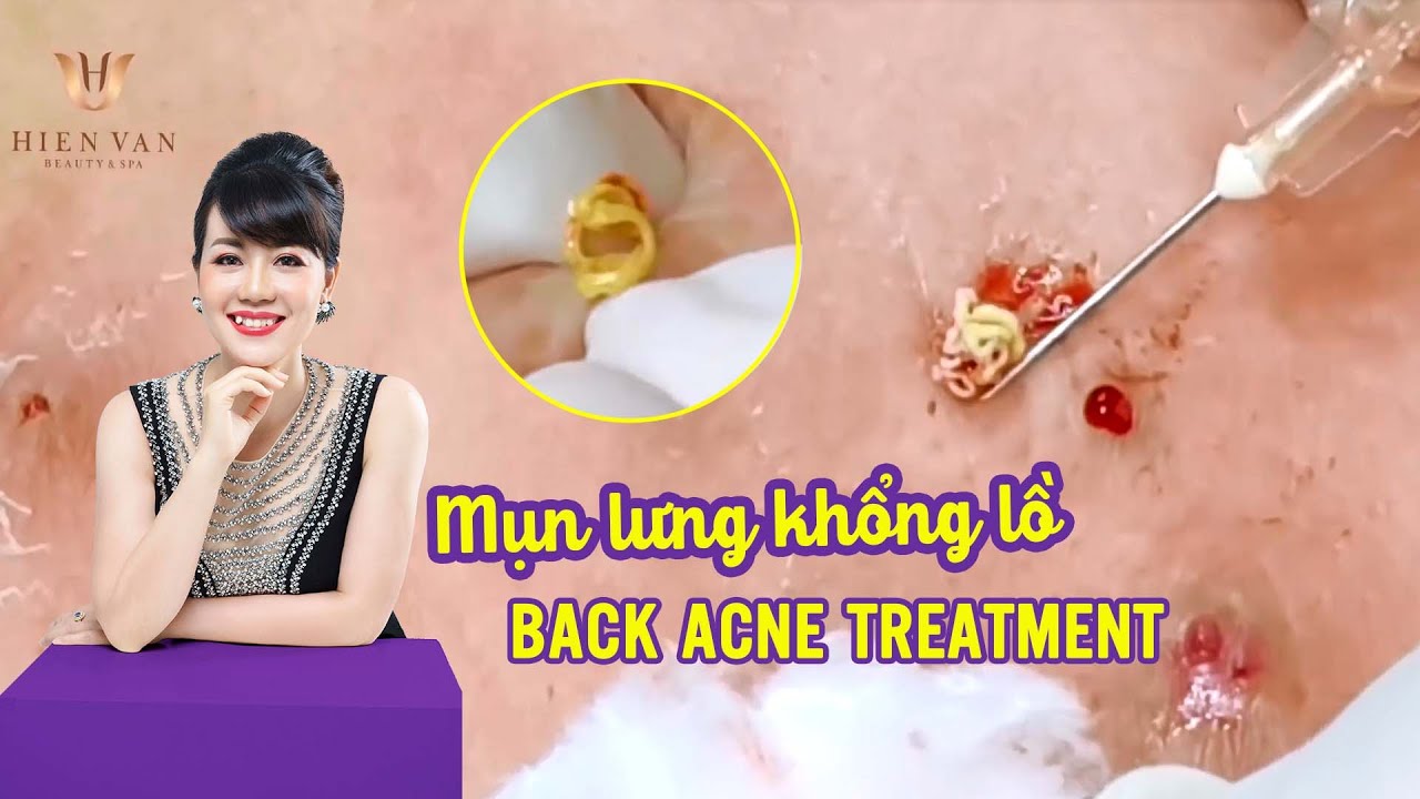Back acne treatment | Điều trị mụn lưng hiệu quả TPHCM | Hiền Vân spa ...