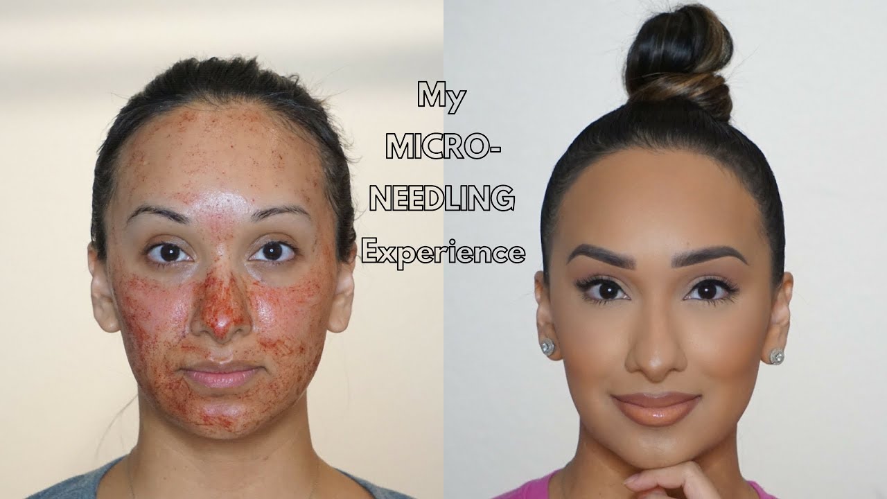 My Microneedling Experience | Makeup by Vicki - YouTube