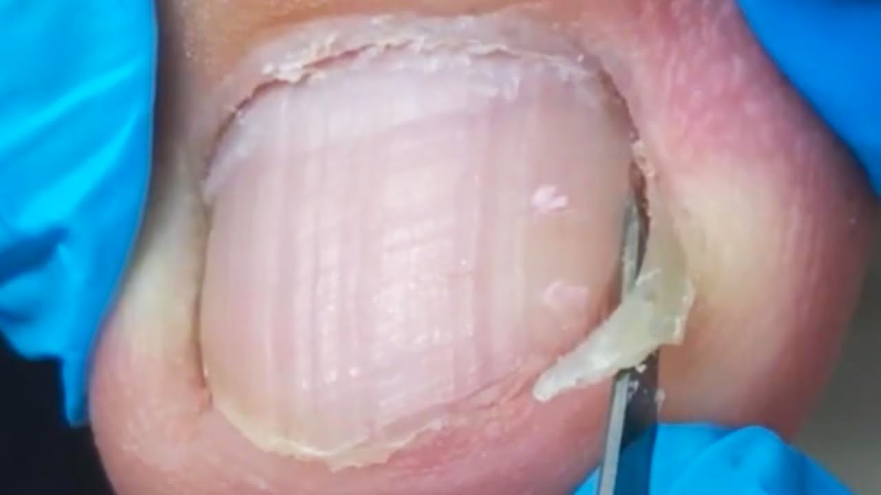 For short toenails, carefully trim off any ingrown toenails【Crazy ...