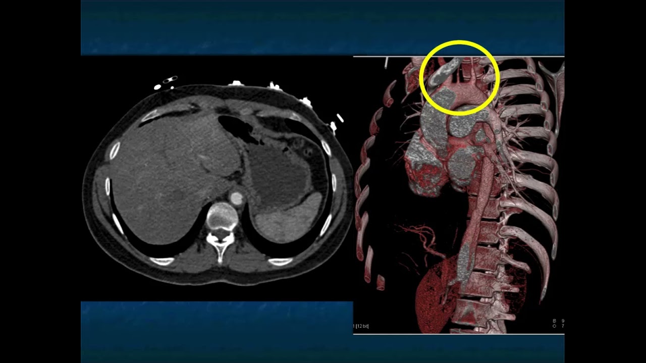 CT Evaluation of Vasculitis: Key Imaging Findings - Part 1 - YouTube