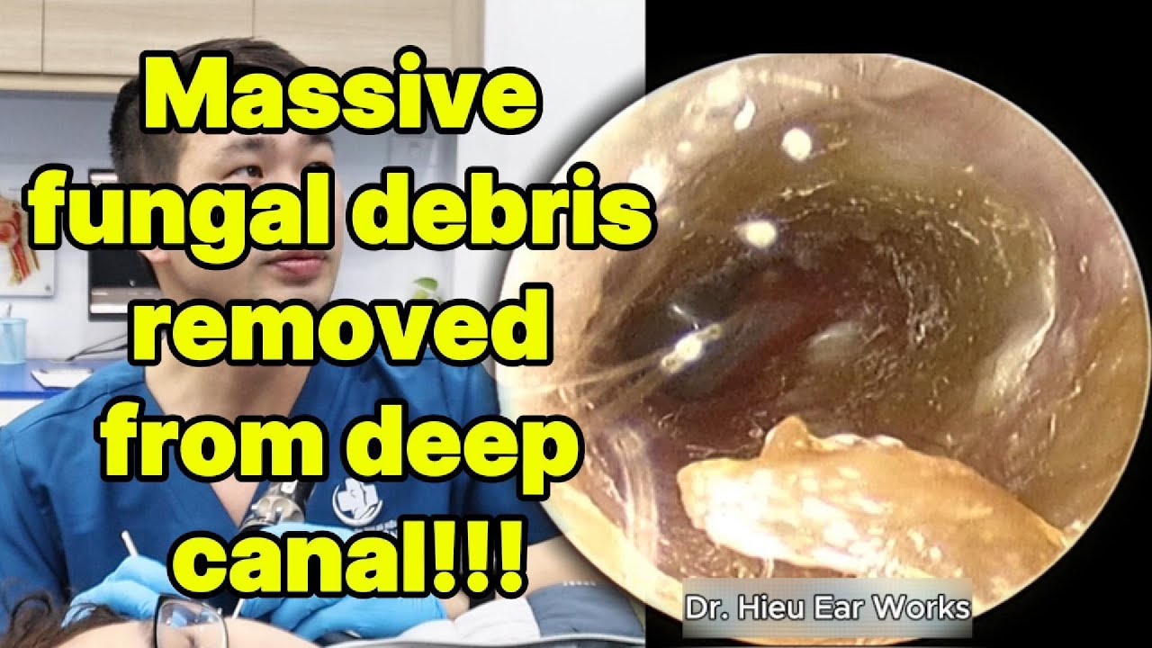 Massive fungal debris removed from deep canal | ear cleaning | ASMR ...