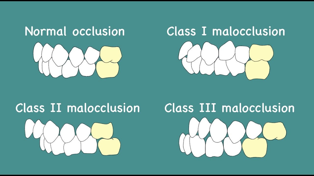 Classification of Malocclusion - YouTube