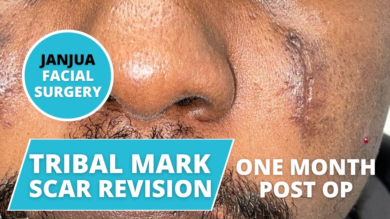 WHAT TO EXPECT AFTER SCAR REVISION SURGERY (ONE MONTH POST OP) - DR ...