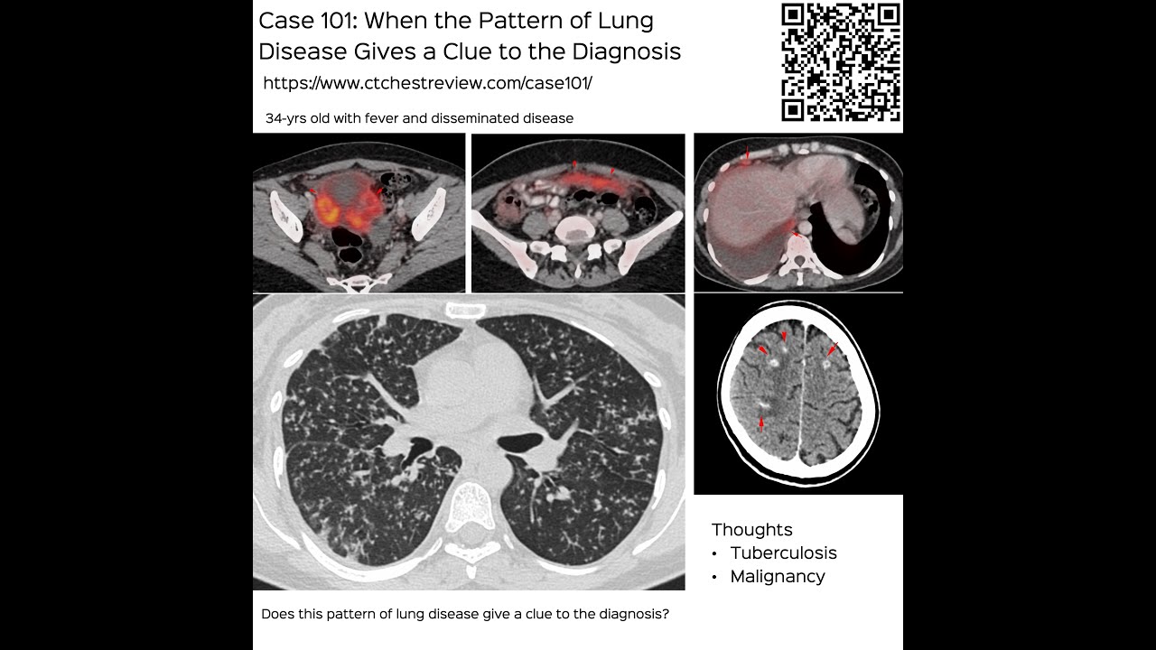 Case 101: When the Pattern of Lung Disease Gives a Clue to the ...