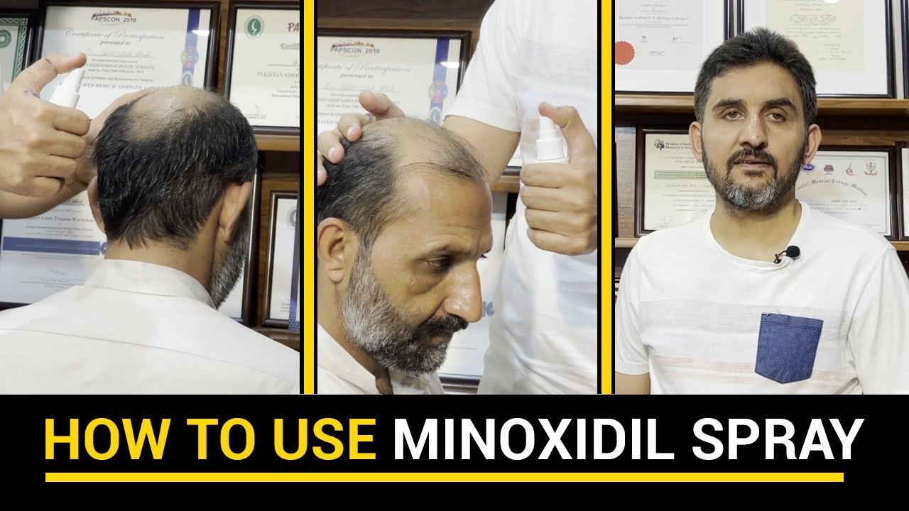 How to use minoxidil spray, Method | Doctor Habib Hair Transplant ...