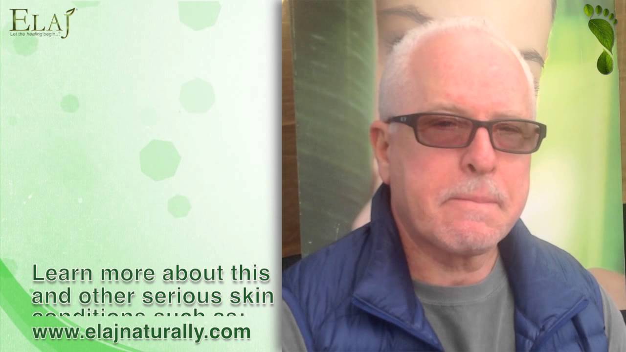 ELAJ FOR SEVERE ITCHING SKIN - YouTube