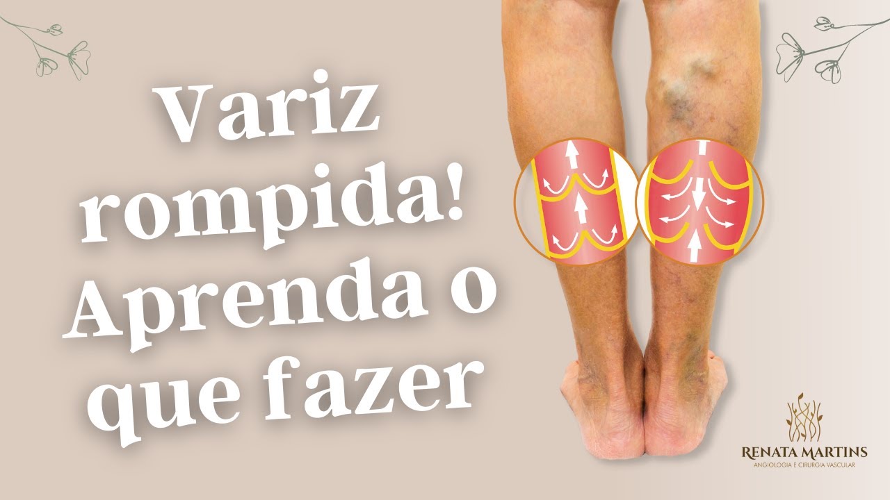 Variz rompida! Descubra o que fazer - YouTube