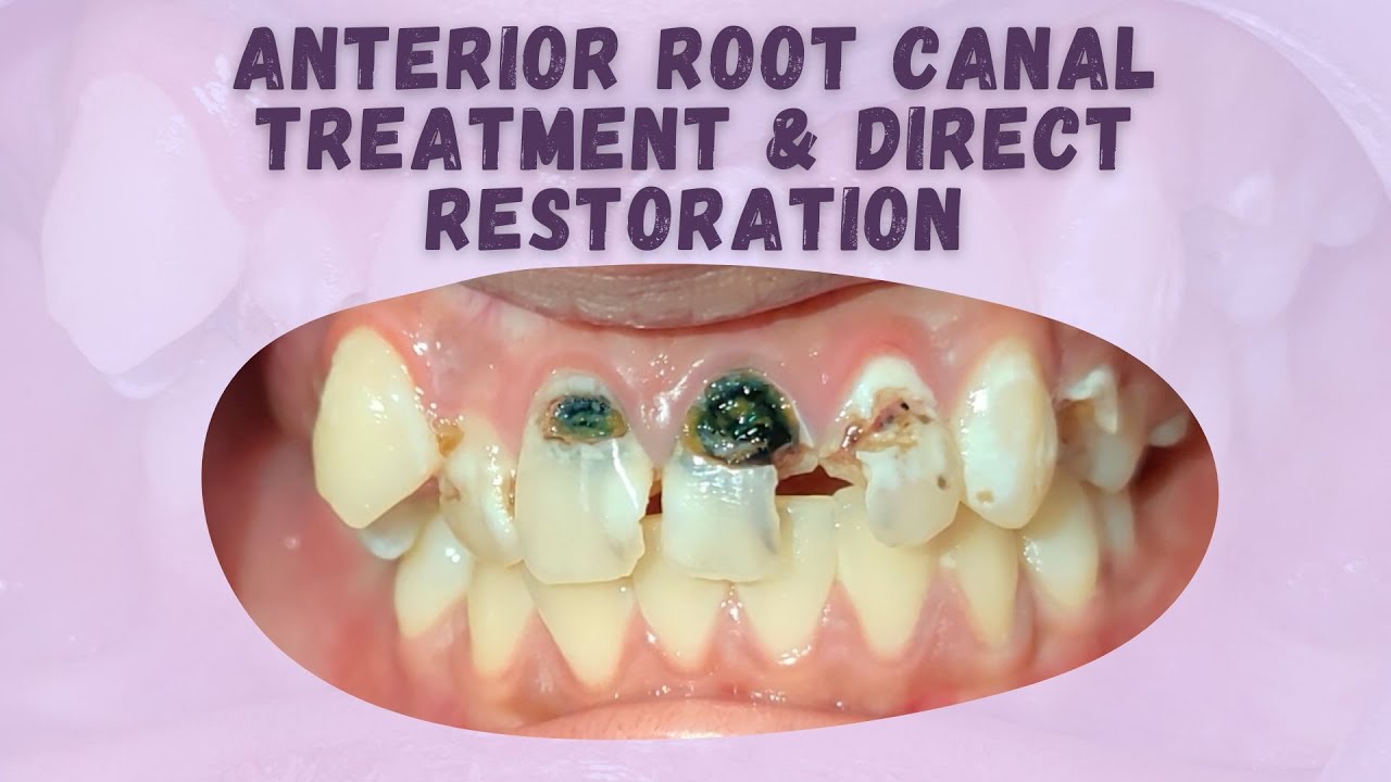 WDC_ ANTERIOR ROOT CANAL TREATMENT & DIRECT RESTORATION | ENDODONTIC ...