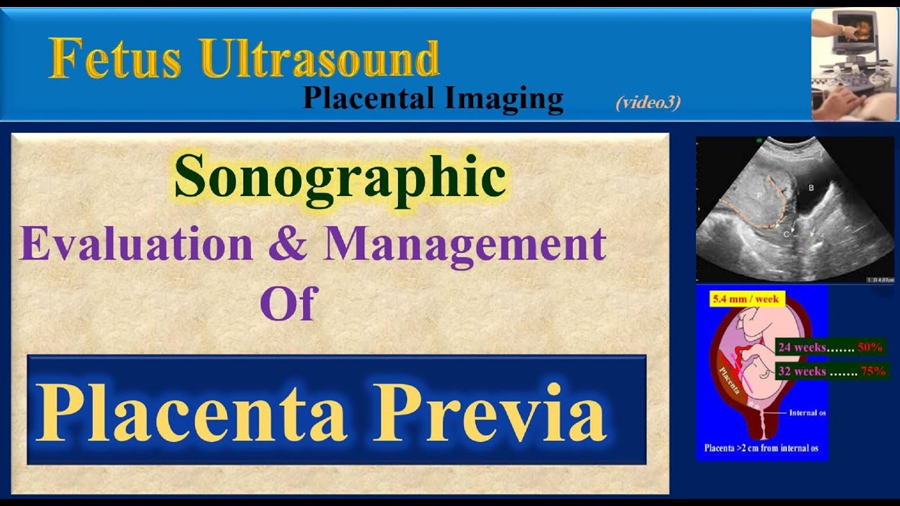 Fetus Ultrasound, Placenta Previa - YouTube