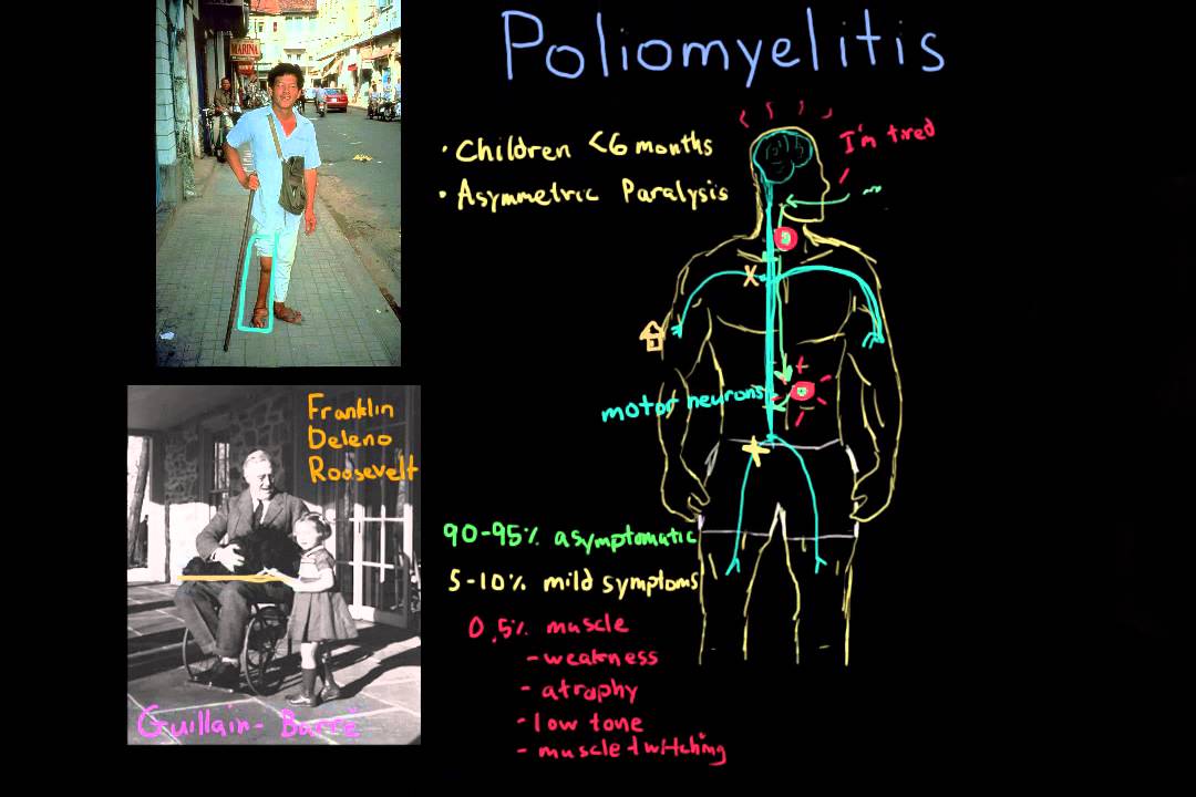 Poliomyelitis Symptoms