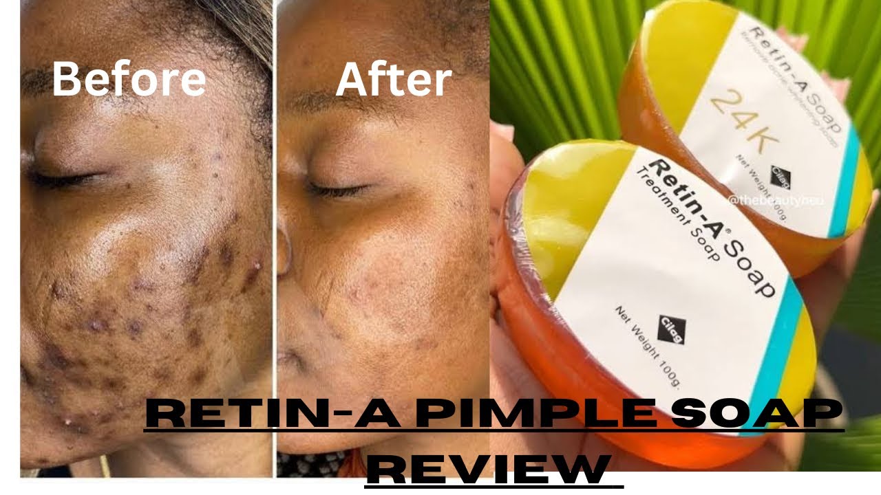 Retin -A pimple soap is very effective 💯( watch before buying) - YouTube