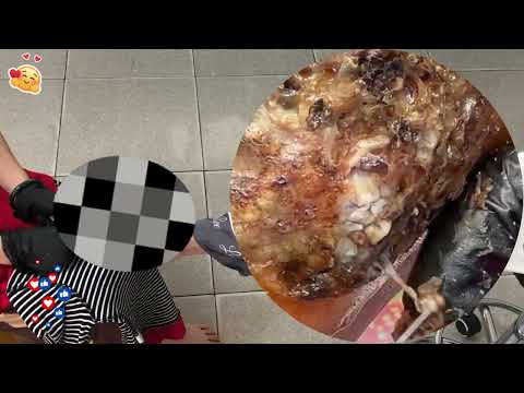 🔥 Extreme Jigger Removal – Skin Eaten Alive and Healing Begins! #SH278