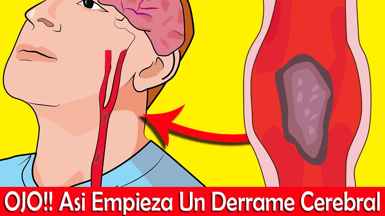 Un Mes Antes De Un Derrame Cerebral Tu Cuerpo Te Envía Estas 10 Señales