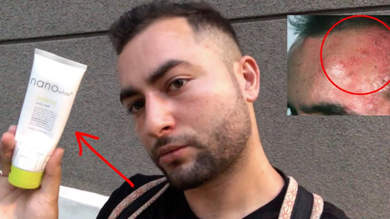 This $4 Japanese Face Wash Cleared ALL My Acne Overnight - YouTube