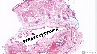 Sebaceous Cyst Scalp Pathology Outlines