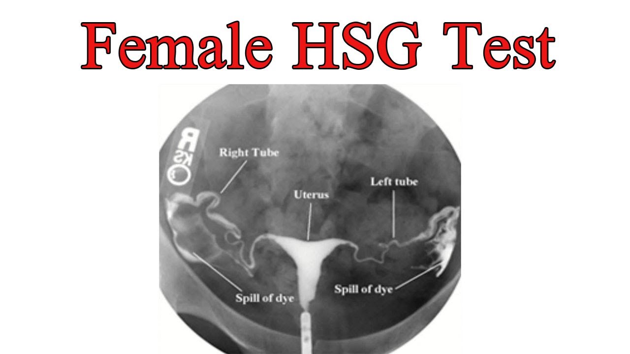 HSG Test YouTube