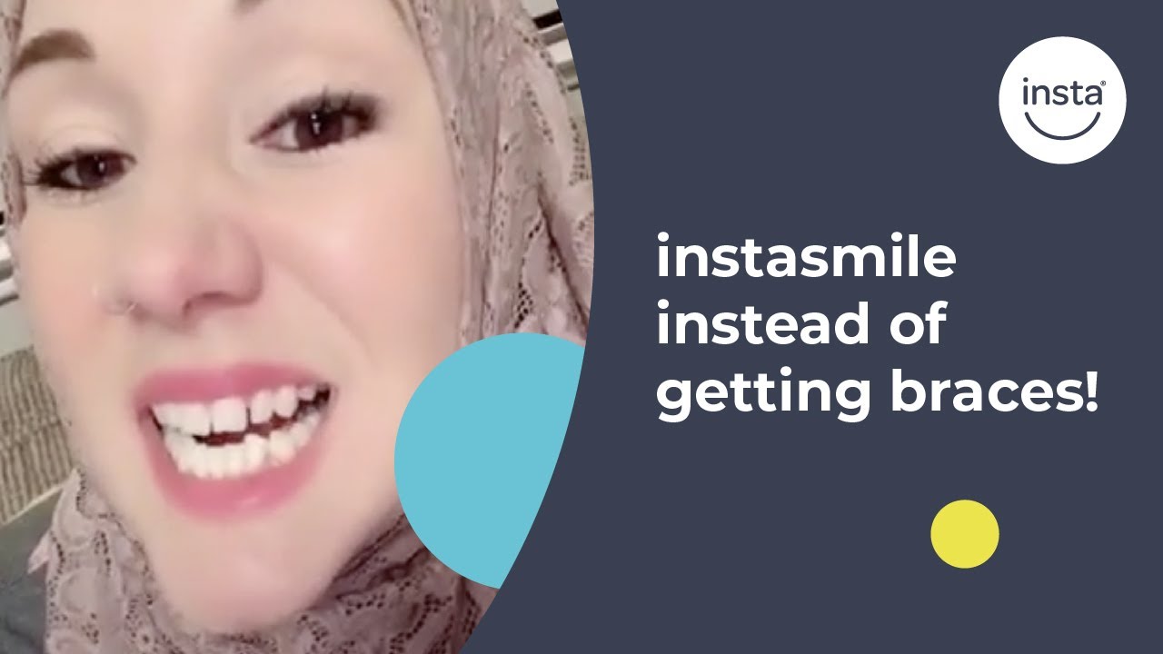 Clip on Veneers Instead of Braces | Apple's Story | Instasmile Review ...