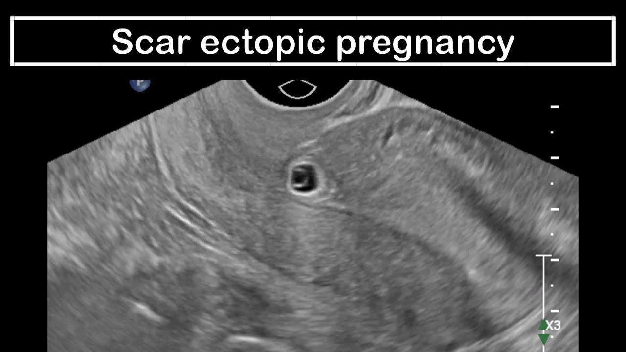 Scar ectopic pregnancy - YouTube