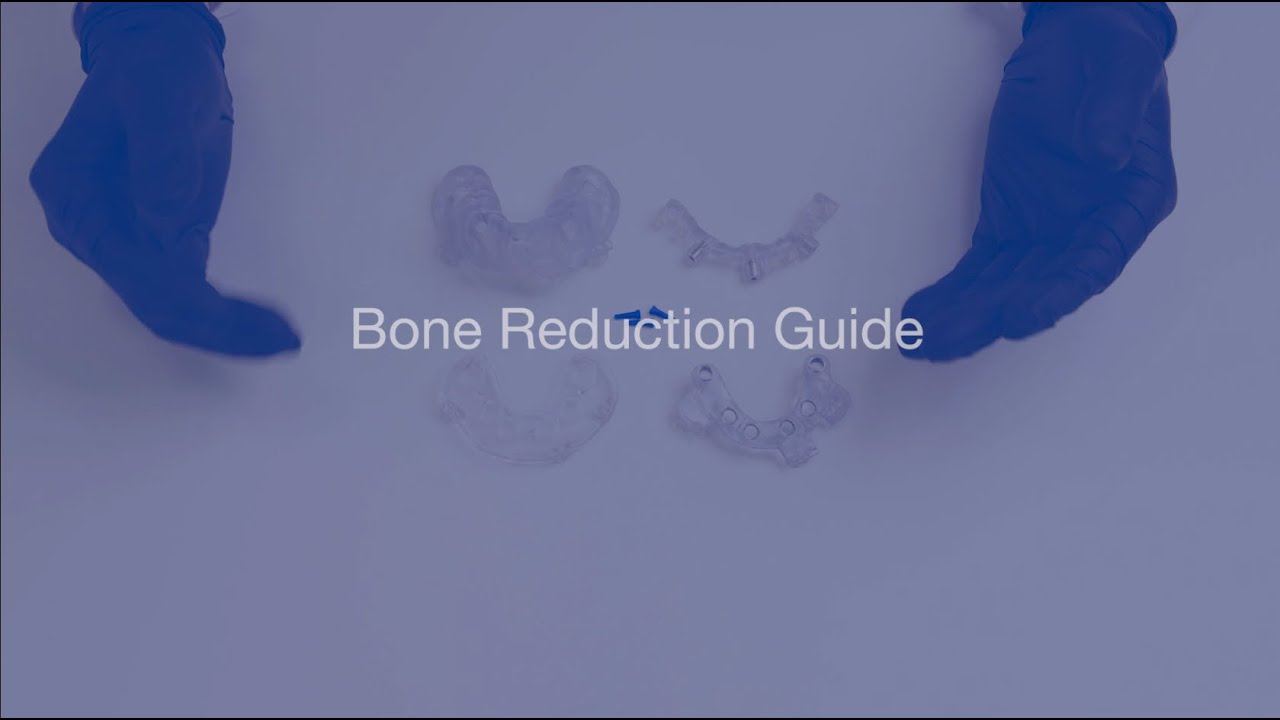 Bone Reduction Guide - YouTube