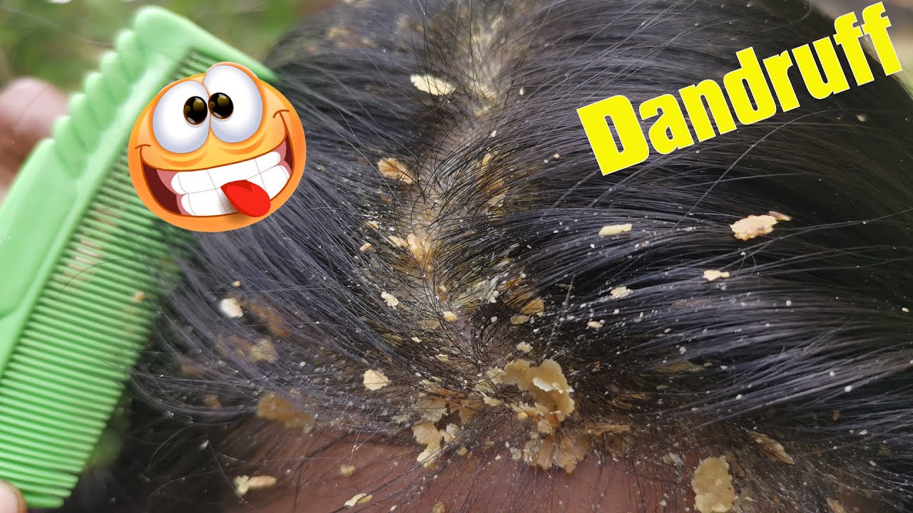 Dandruff Removal - Itchy Scratching, Huge Flakes, Part 154 - YouTube