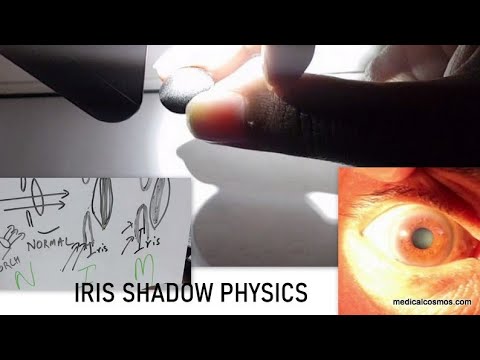 IRIS SHADOW CONCEPT - Immature vs Mature Cataract - YouTube