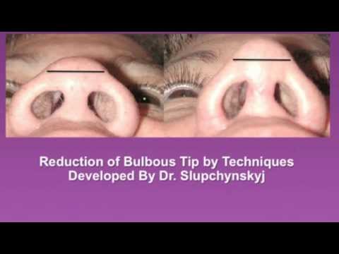 Bulbous Tip Rhinoplasty - Defatting the Tip - YouTube