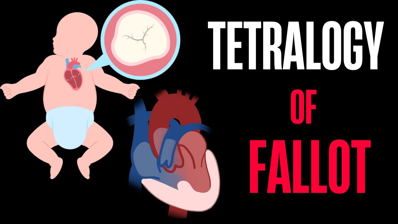 Tetralogy of Fallot (TOF) - NCLEX High-Yield 💙 | Pathophysiology ...