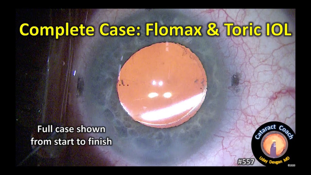 Complete Cataract Case: Flomax & Toric IOL - YouTube